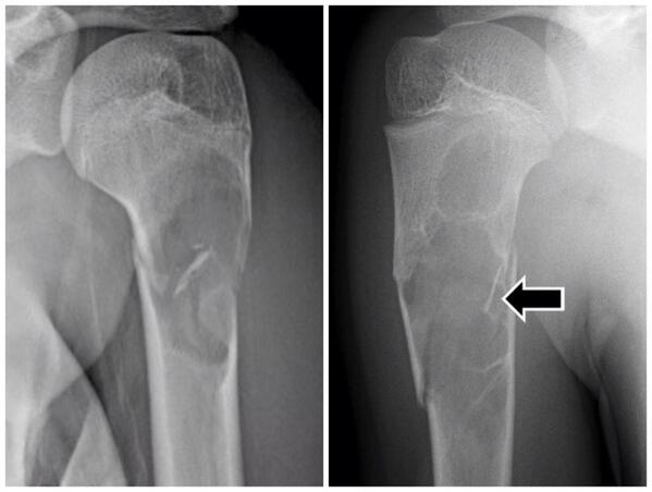 Simple Bone Cyst Fallen Fragment Sign