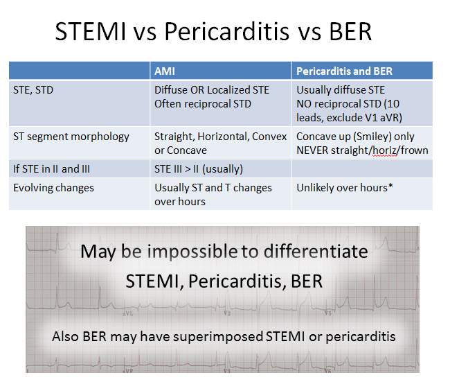 Pericarditis Vs Stemi Ecg