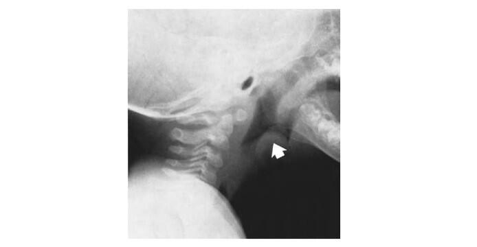Epiglottis Thumbprint Sign
