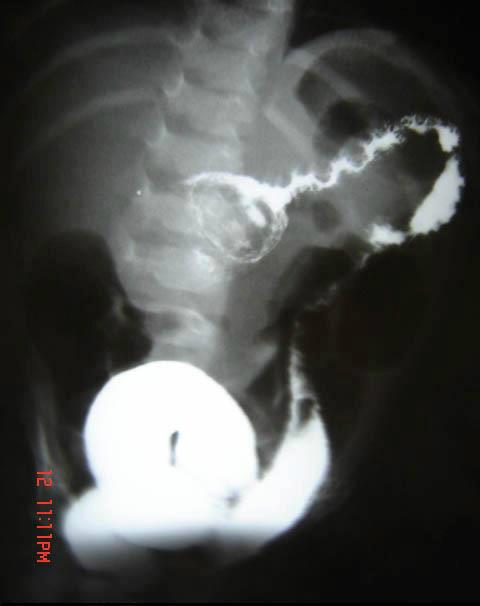 Intussusception Claw Sign