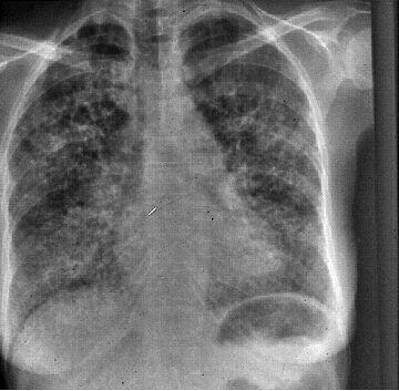 Idiopathic Pulmonary Fibrosis Chest X Ray