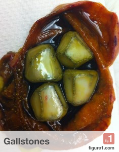Real Gallbladder Stones