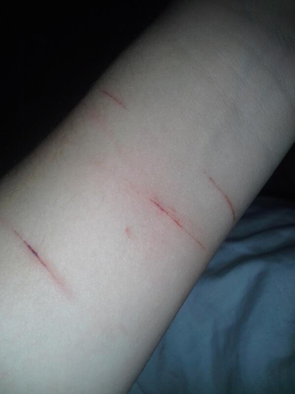 Cuts On Girls Wrist