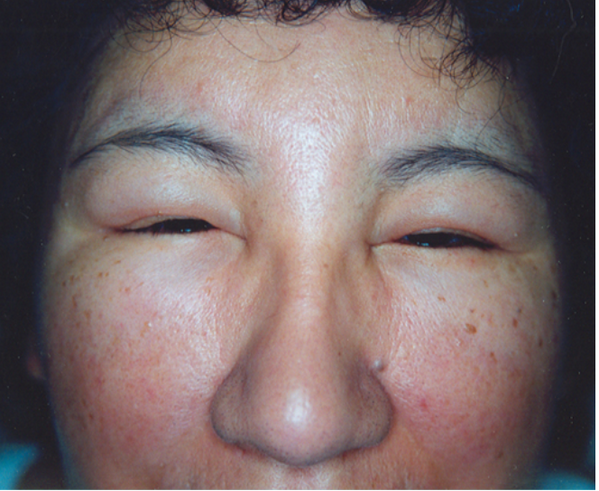 No complicado destacar General edema rostro Stratford on Avon Conjugado ...