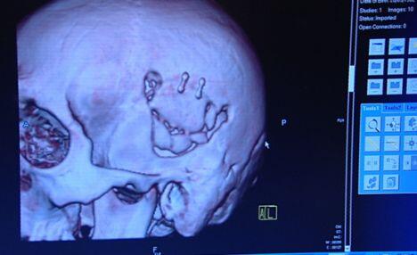 Petr Cech Head Injury Video