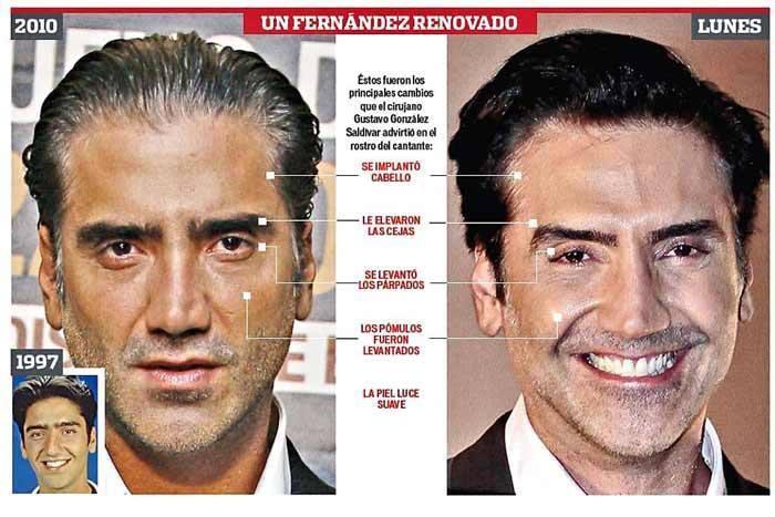 Alejandro Fernandez Cirugia Antes Y Despues