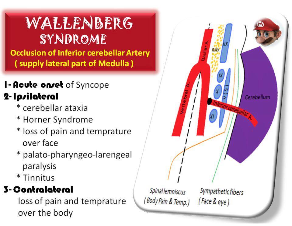 Medial Medullary Syndrome Mnemonic