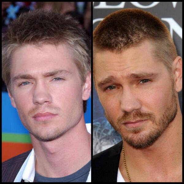 Chad Michael Murray Before And After Nose Job