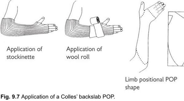 Colles Fracture Backslab