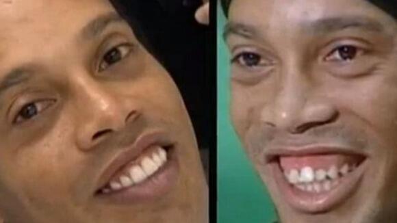 Ronaldinho Teeth Ronaldinho Has Goofy Teeth Fixed In Operation WATCH
