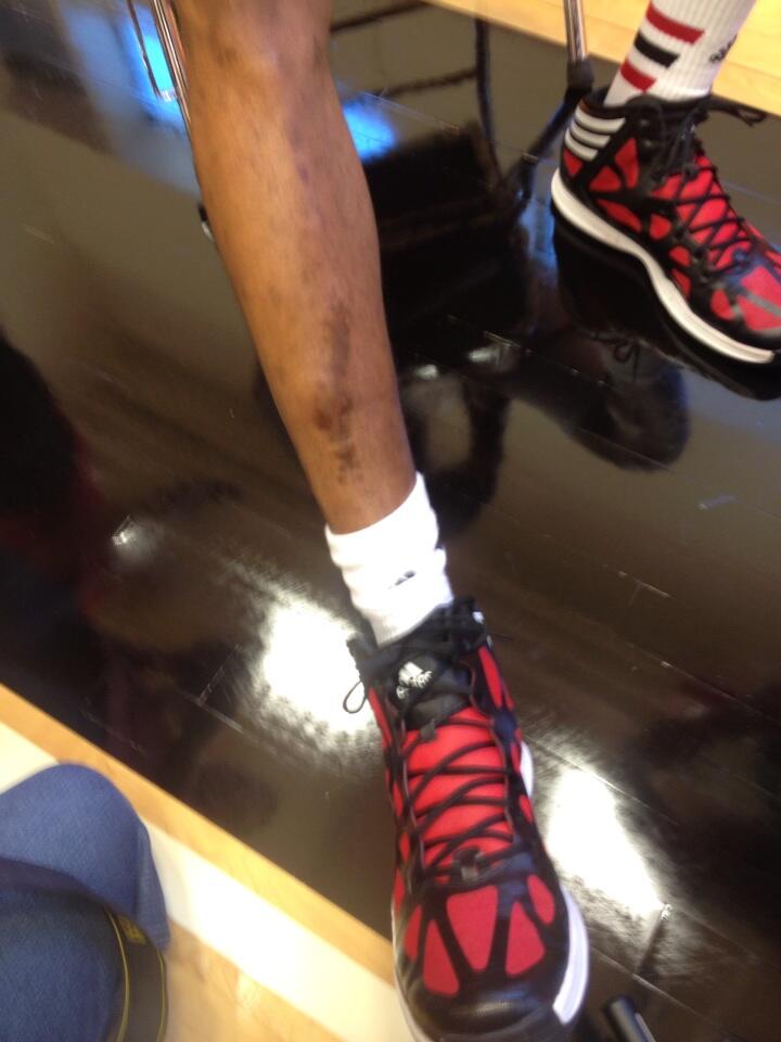 Kevin Ware Broken Leg Lion King