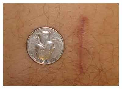 Microdiscectomy Scar