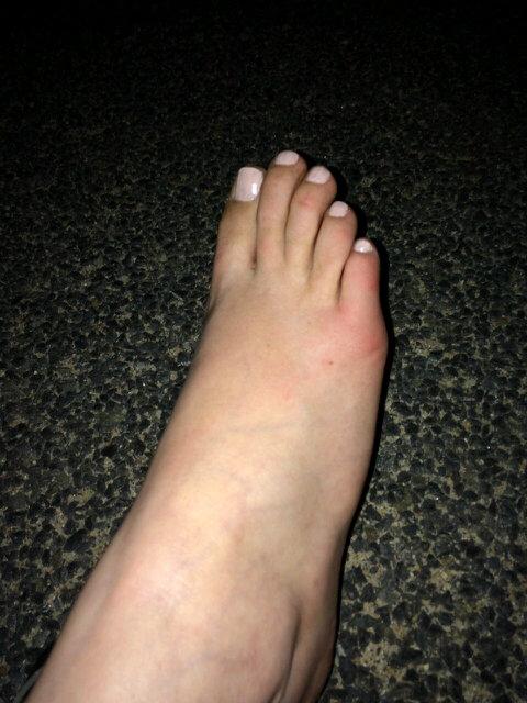 Scorpion Sting On Foot