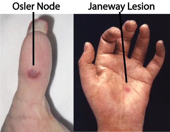 Janeway Lesions Causes
