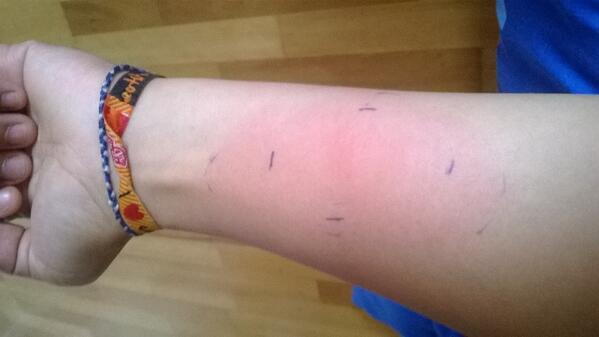 White Tail Spider Bite Day 1