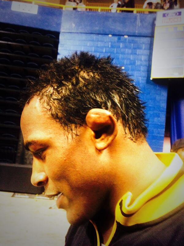 Really Bad Cauliflower Ear
