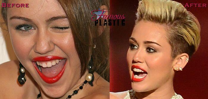 Miley Cyrus Teeth Before And After
