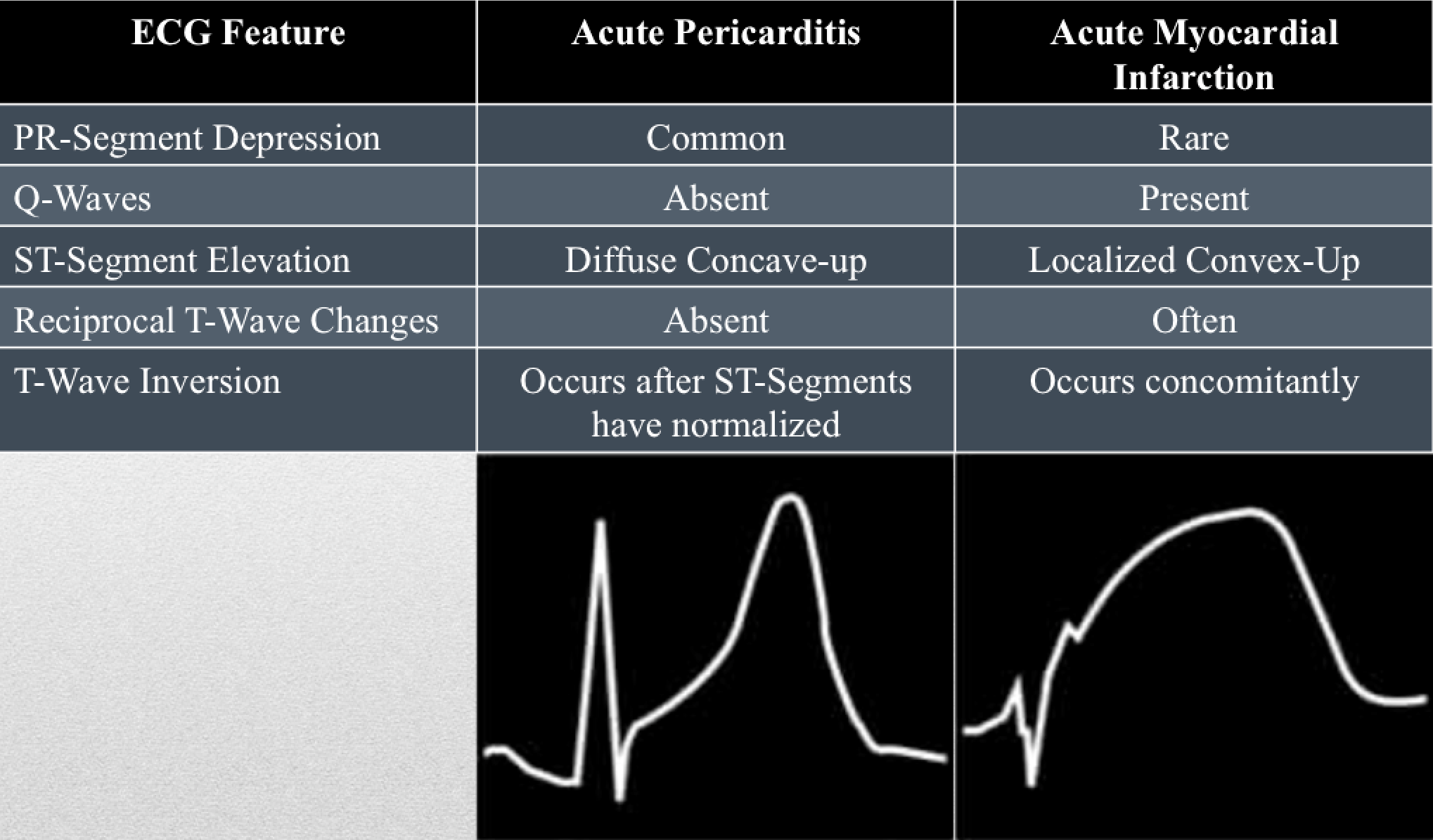 Constrictive Pericarditis Ecg