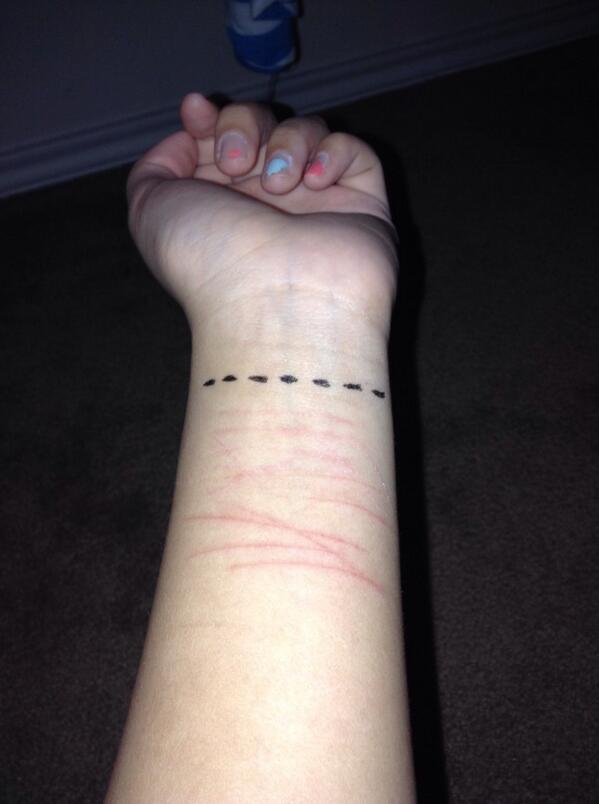 Wrist Cutting Scars