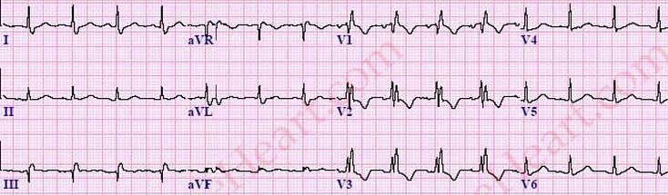 Right Bundle Branch Block