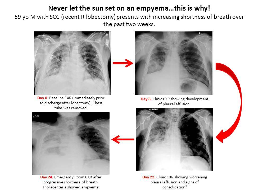 Massive Pleural Effusion X Ray