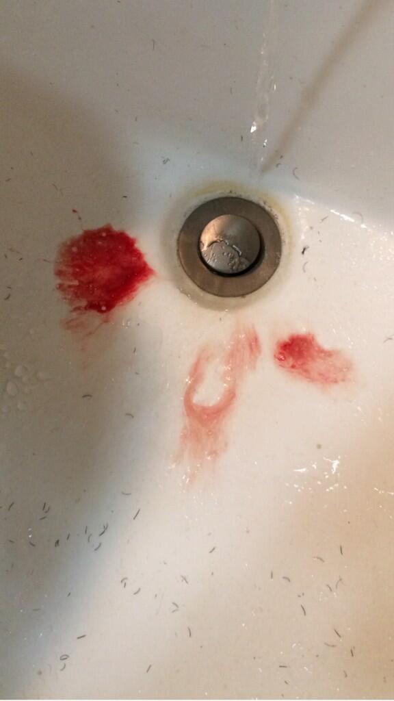 Coughing Up Blood With Mucus