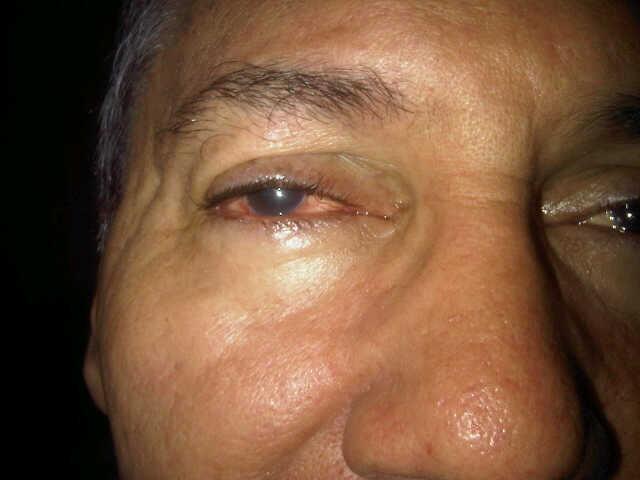 Baya balcón Transparente valvula para el ojo con glaucoma desarrollo de ...