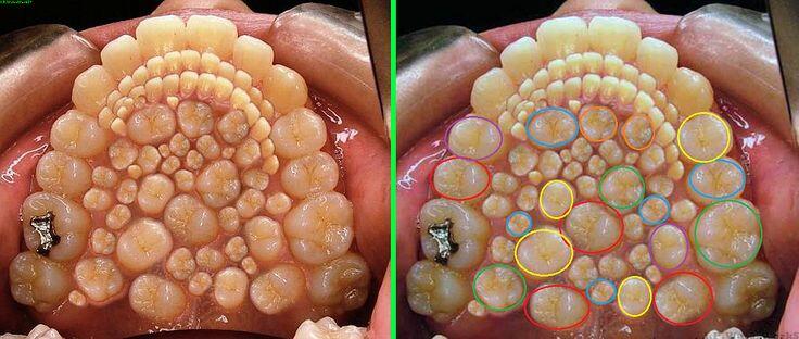 Multiple Hyperdontia