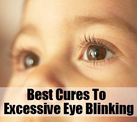 Excessive Blinking