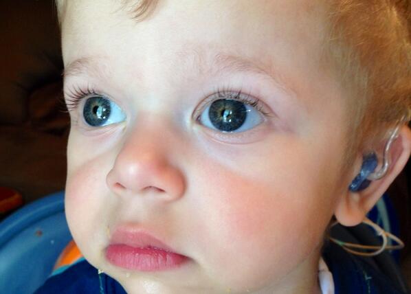 Williams Syndrome Eyes