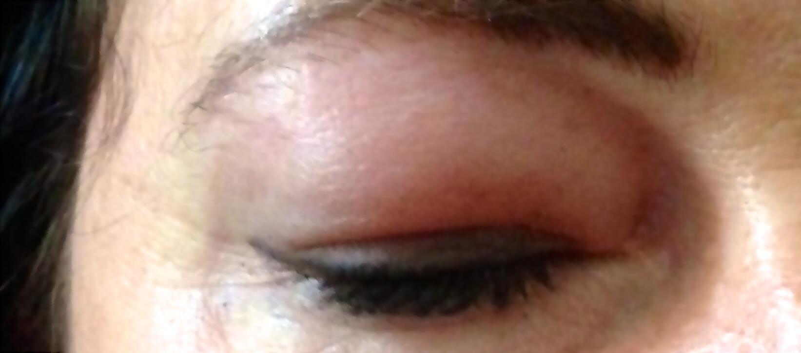 Gabrielle Eye Ptosis