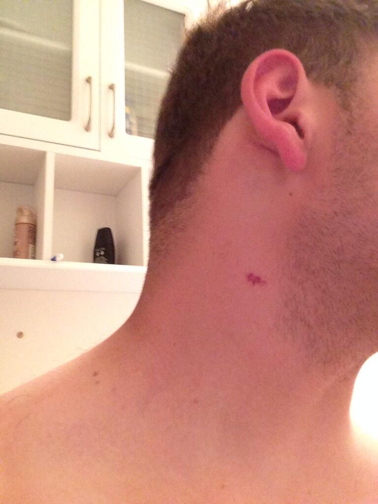 Hickey On Neck