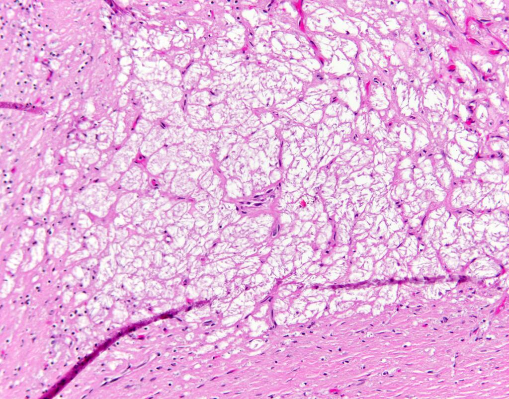 Foam Cell Atherosclerosis