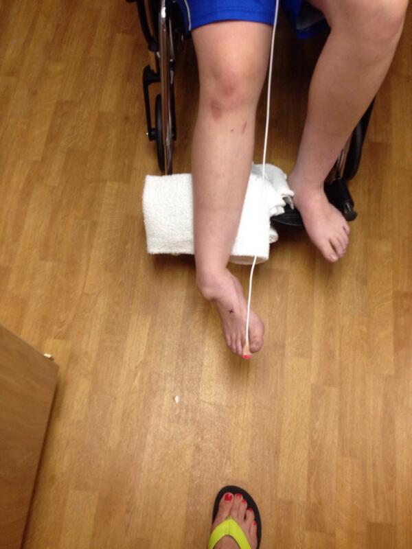 Dislocated Ankle