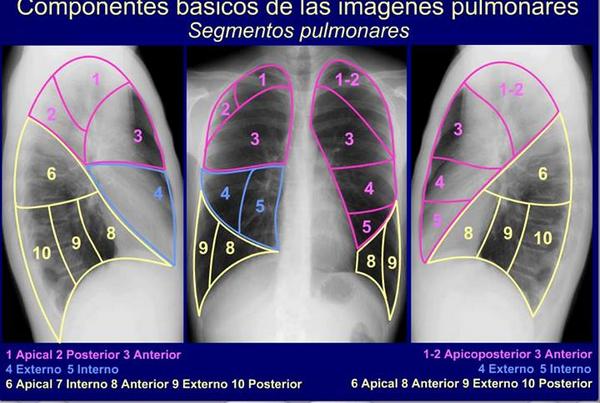 Segmentos Broncopulmonares