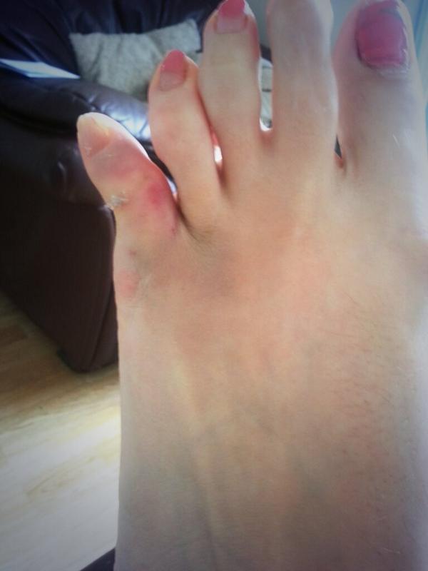 Dislocated Pinky Toe