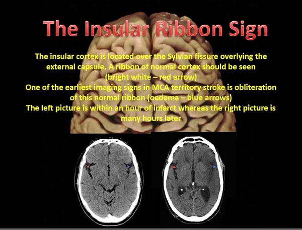Insular Ribbon Sign