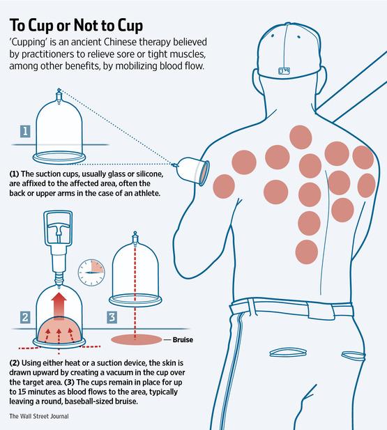 Mets latch on to cupping therapy with baseball-sized bruises | WSJ ...