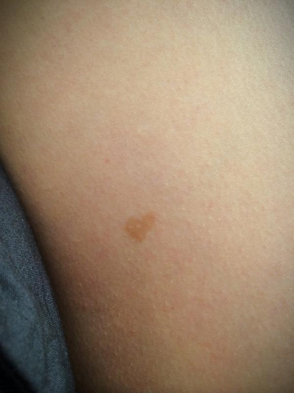 Heart Birthmark
