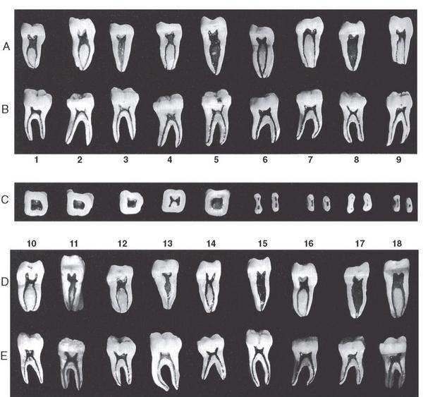 Mandibular First Molar Canals