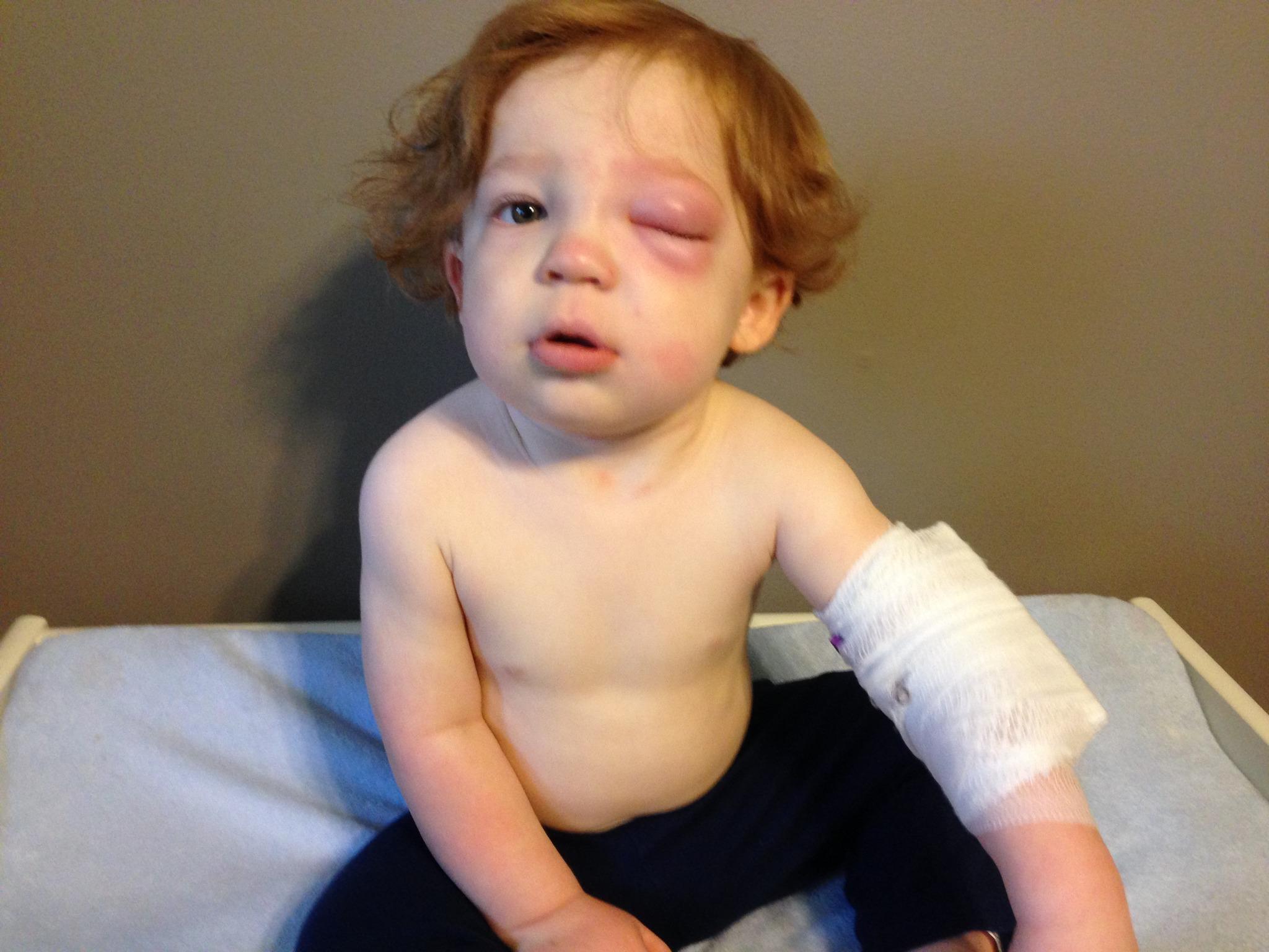 Periorbital Cellulitis Infant