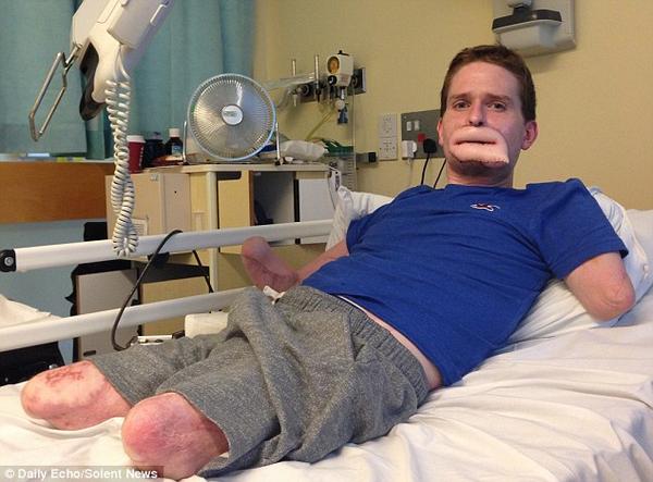 Man who lost lips and limbs to flesh-eating bug has surgery to rebuild ...
