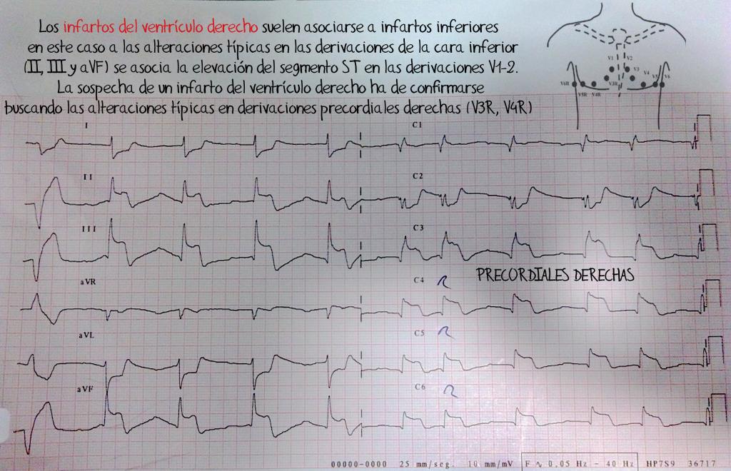 Electrocardiograma Infarto