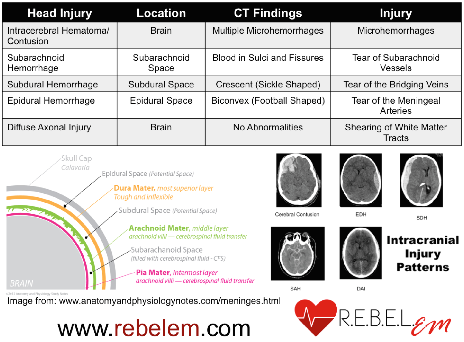 Types Of Brain Hemorrhage