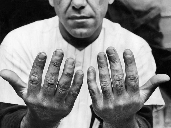 Can we see some comparison photos of catchers hands after catching ~100 ...