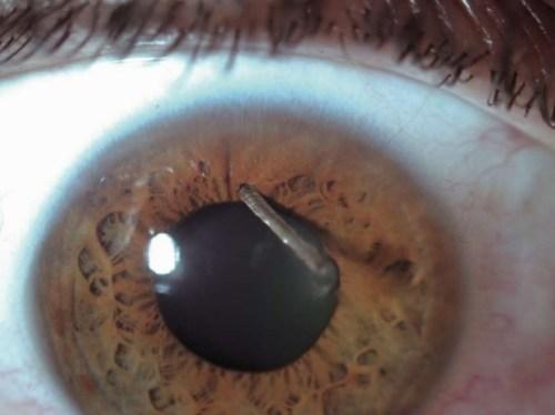 Penetrating Eye Injury