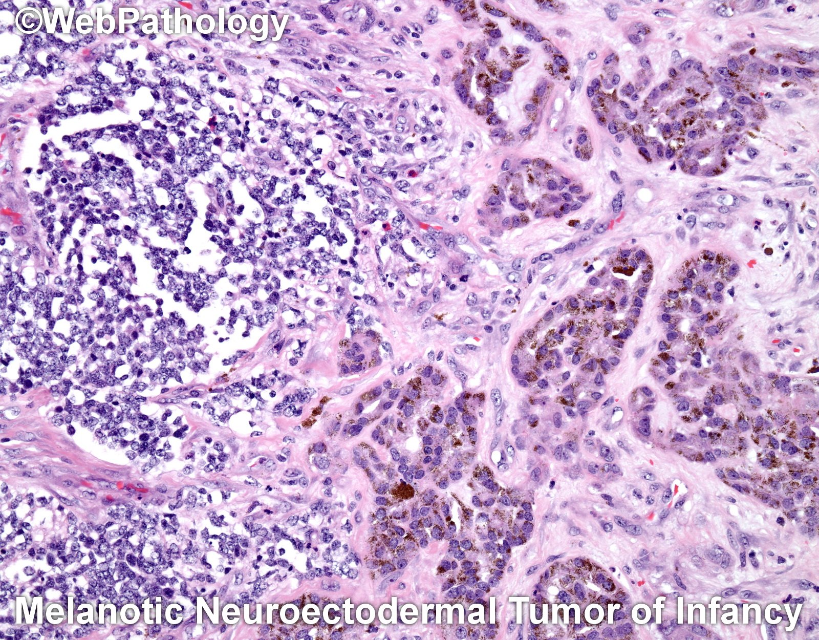 Melanotic Neuroectodermal Tumor Of Infancy