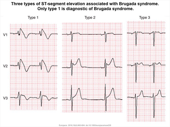 Diagram Of St Elevation