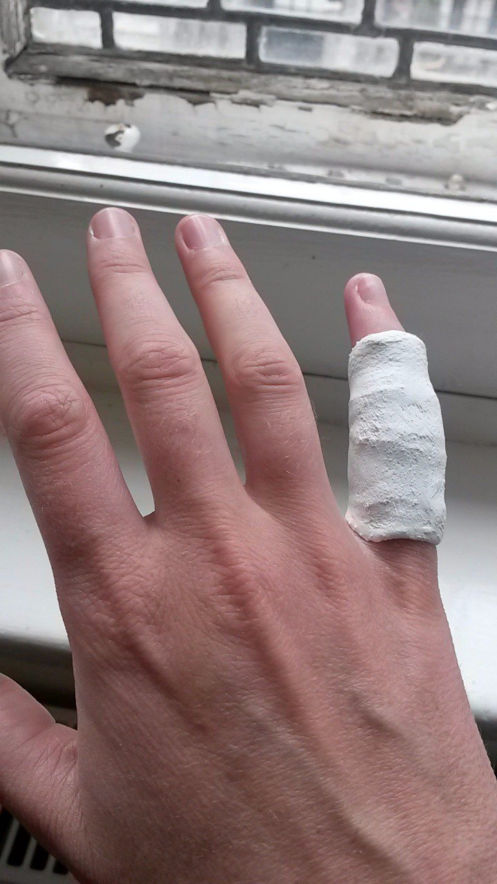 Broken Finger Cast