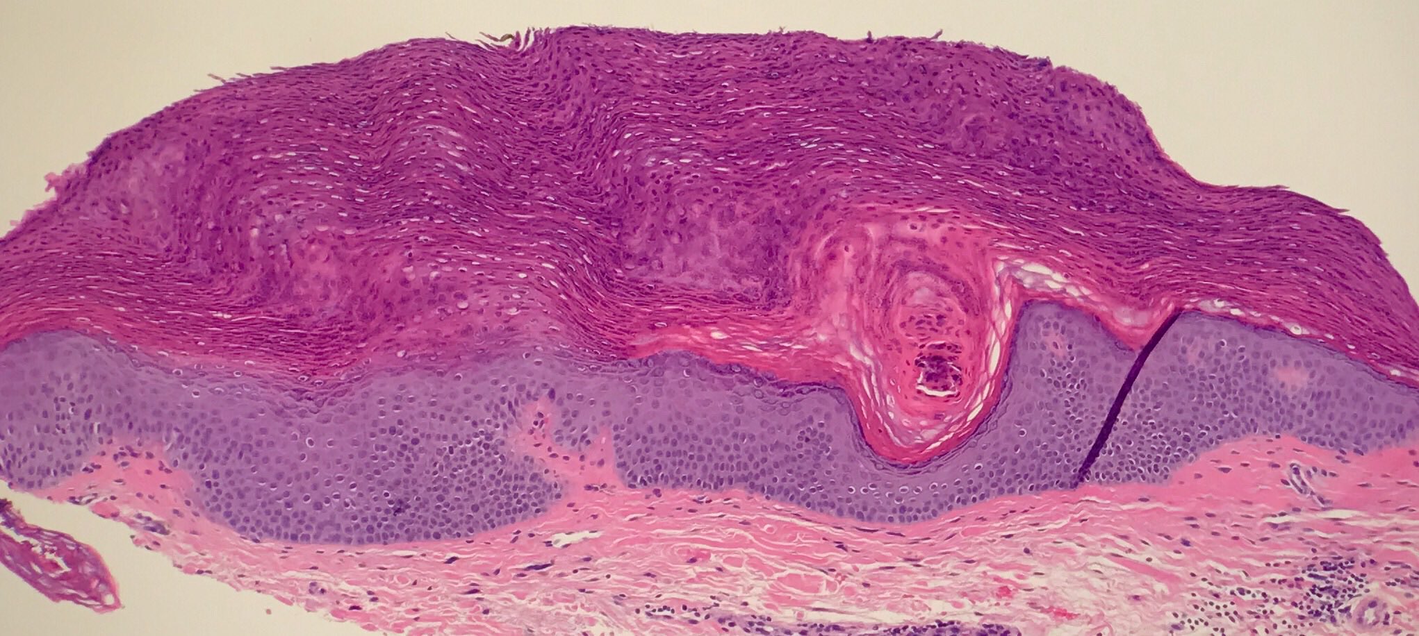 Granular Parakeratosis Histology